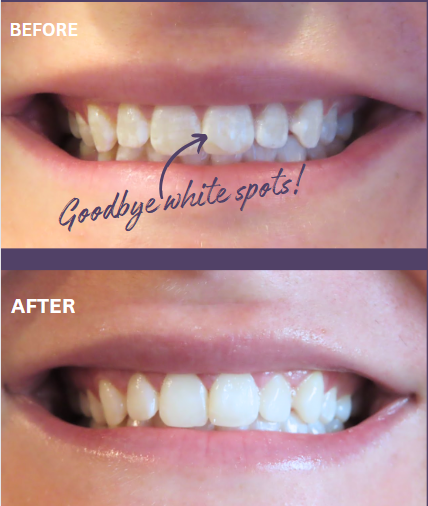 ICON Spot Treatment - Northstar Family Dental