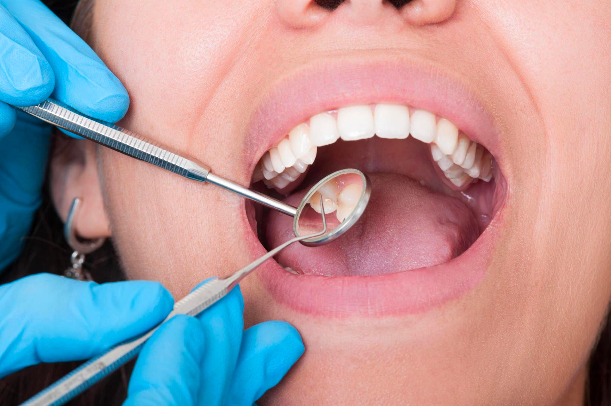 Dental Cavitations: Understanding Causes, Symptoms, and Treatments