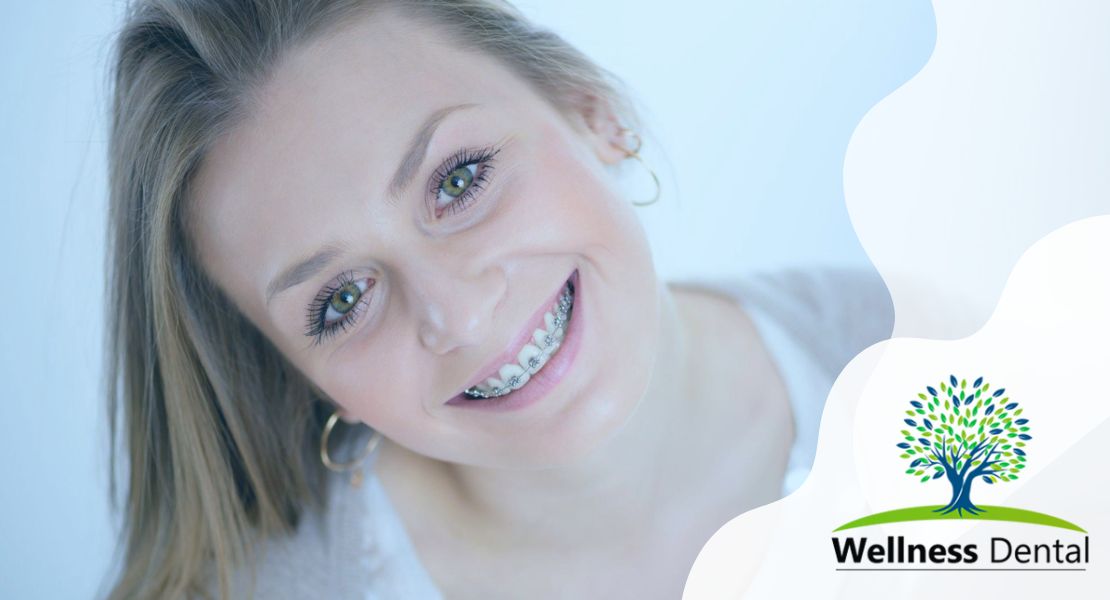Orthodontic Spacers: Types, Uses, and Importance in Creating Space for ...