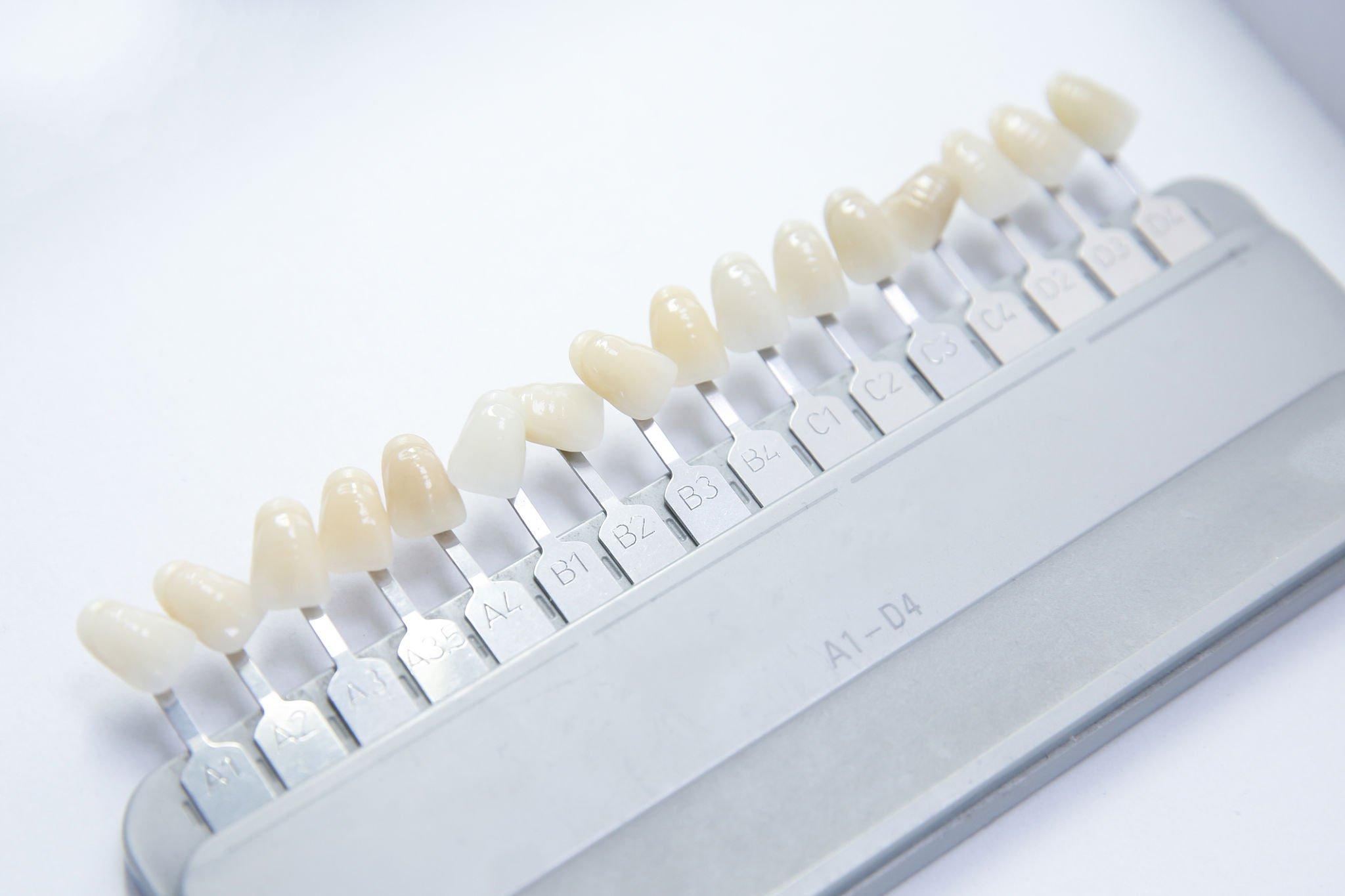 Teeth Prepped for Veneers: A Conservative Step-by-Step Process