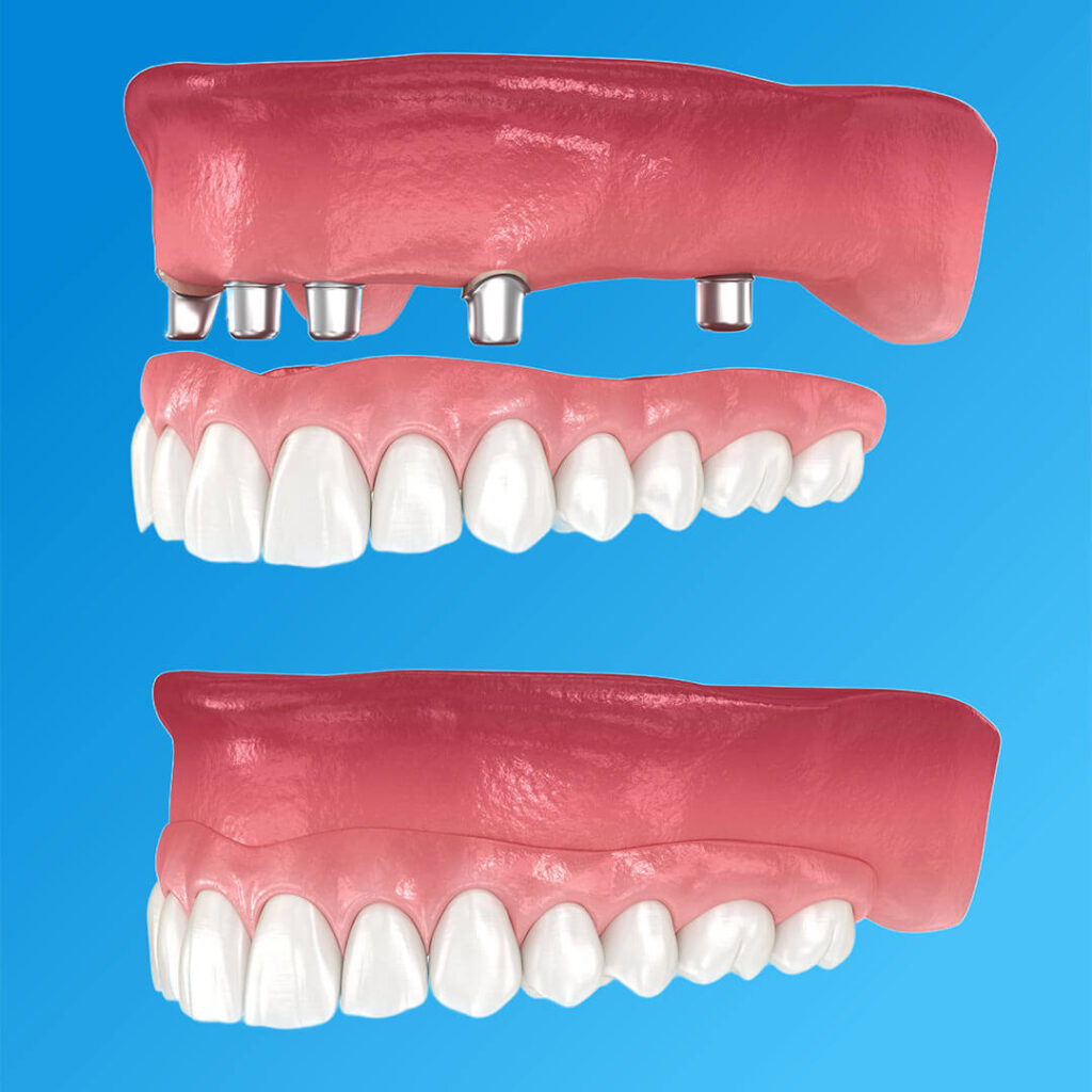 Snap-In Dentures - Smile Cape Coral
